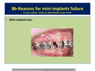 126 failure mini-implant-miniscrews in orthodontics-case report-oussama ...