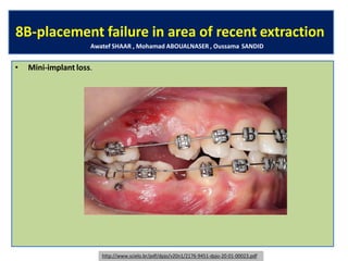 126 failure mini-implant-miniscrews in orthodontics-case report-oussama ...