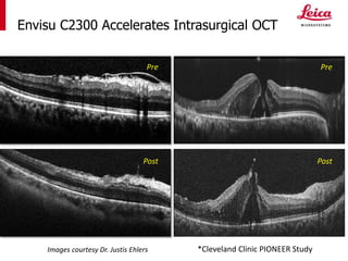 RETINA COMPANY SHOWCASE - Bioptigen | PPT | Free Download