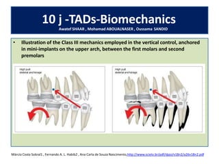 128 miniscrews in orthodontics biomechanics-casereport-oussama sandid ...