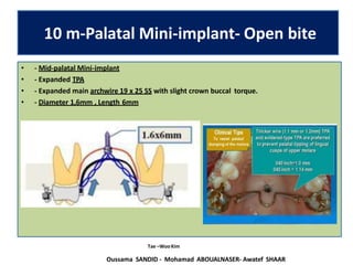 128 miniscrews in orthodontics biomechanics-casereport-oussama sandid ...