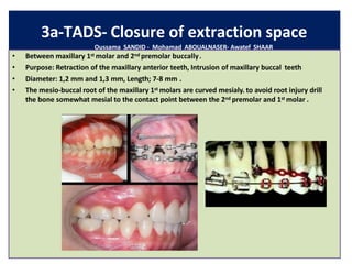129 temporary anchorage devices in orthodontics-miniscrews-mini ...