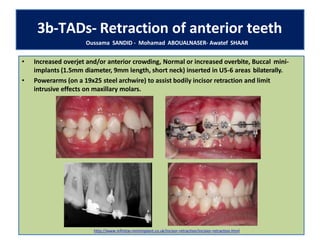 129 temporary anchorage devices in orthodontics-miniscrews-mini ...