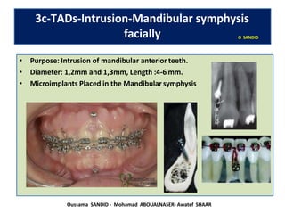 129 temporary anchorage devices in orthodontics-miniscrews-mini ...