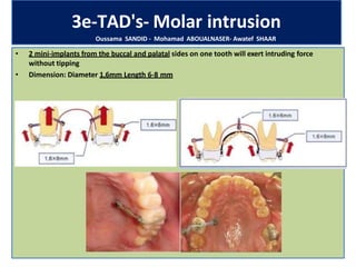 129 temporary anchorage devices in orthodontics-miniscrews-mini ...