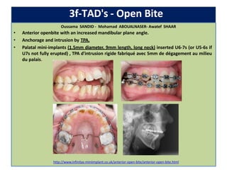 129 temporary anchorage devices in orthodontics-miniscrews-mini ...