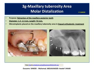 129 temporary anchorage devices in orthodontics-miniscrews-mini ...