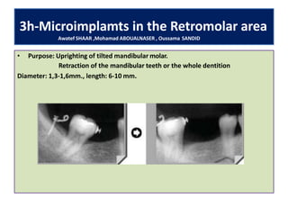 129 temporary anchorage devices in orthodontics-miniscrews-mini ...