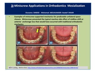 129 temporary anchorage devices in orthodontics-miniscrews-mini ...