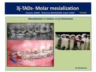 129 temporary anchorage devices in orthodontics-miniscrews-mini ...