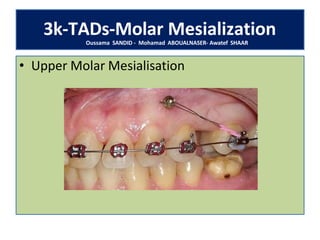 129 temporary anchorage devices in orthodontics-miniscrews-mini ...