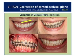 129 temporary anchorage devices in orthodontics-miniscrews-mini ...