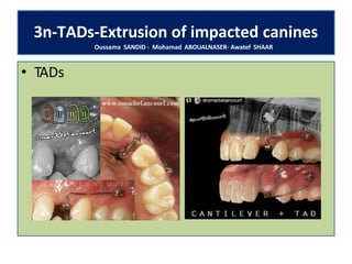 129 temporary anchorage devices in orthodontics-miniscrews-mini ...