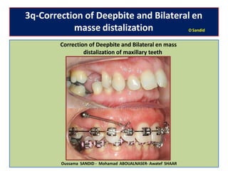 129 temporary anchorage devices in orthodontics-miniscrews-mini ...