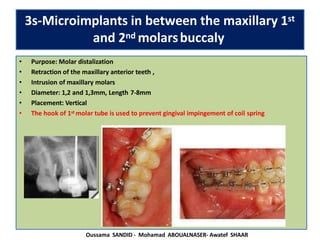 129 temporary anchorage devices in orthodontics-miniscrews-mini ...
