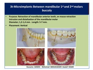 129 temporary anchorage devices in orthodontics-miniscrews-mini ...