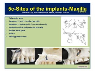 129 temporary anchorage devices in orthodontics-miniscrews-mini ...