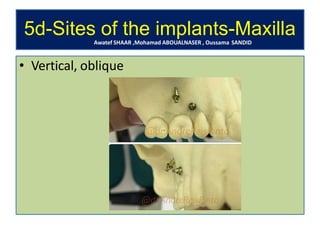 129 temporary anchorage devices in orthodontics-miniscrews-mini ...