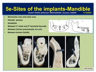 129 temporary anchorage devices in orthodontics-miniscrews-mini ...