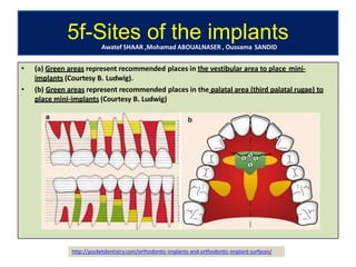 129 temporary anchorage devices in orthodontics-miniscrews-mini ...