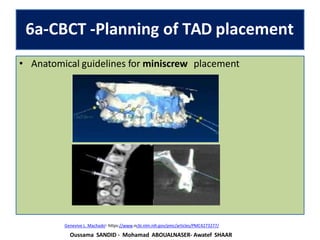 129 temporary anchorage devices in orthodontics-miniscrews-mini ...