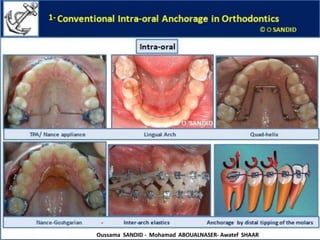 129 temporary anchorage devices in orthodontics-miniscrews-mini ...
