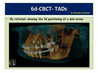 129 temporary anchorage devices in orthodontics-miniscrews-mini ...