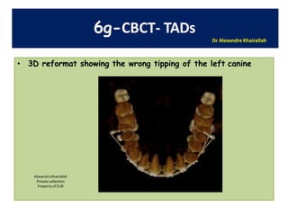 129 temporary anchorage devices in orthodontics-miniscrews-mini ...
