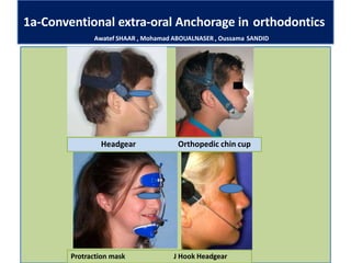 129 temporary anchorage devices in orthodontics-miniscrews-mini ...