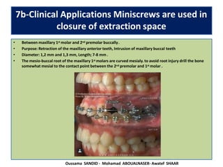129 temporary anchorage devices in orthodontics-miniscrews-mini ...