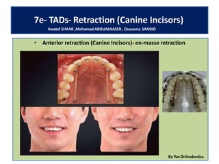 129 temporary anchorage devices in orthodontics-miniscrews-mini ...