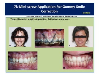 129 temporary anchorage devices in orthodontics-miniscrews-mini ...