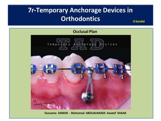 129 temporary anchorage devices in orthodontics-miniscrews-mini ...