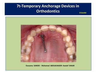 129 temporary anchorage devices in orthodontics-miniscrews-mini ...