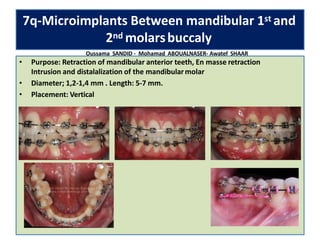 129 temporary anchorage devices in orthodontics-miniscrews-mini ...