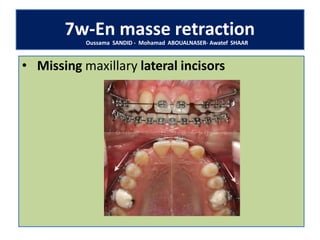 129 temporary anchorage devices in orthodontics-miniscrews-mini ...