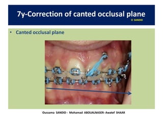 129 temporary anchorage devices in orthodontics-miniscrews-mini ...