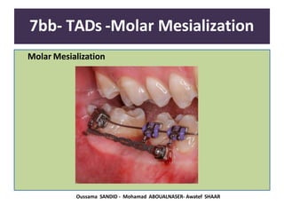 129 temporary anchorage devices in orthodontics-miniscrews-mini ...