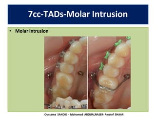 129 temporary anchorage devices in orthodontics-miniscrews-mini ...
