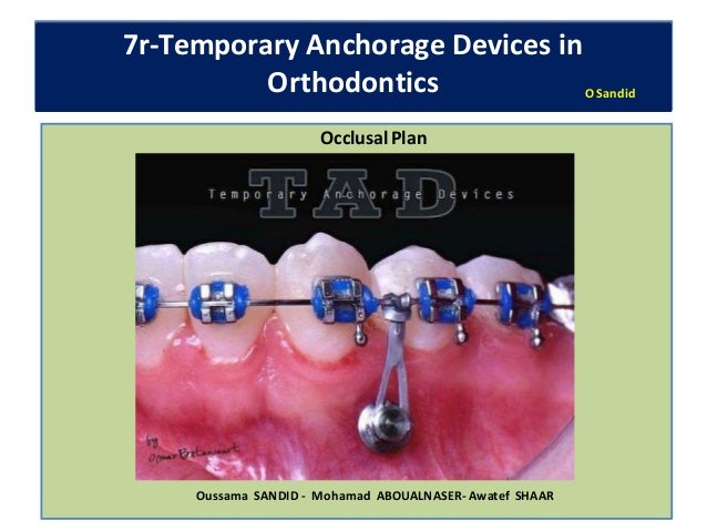 129 temporary anchorage devices in orthodontics-miniscrews-mini-impla…