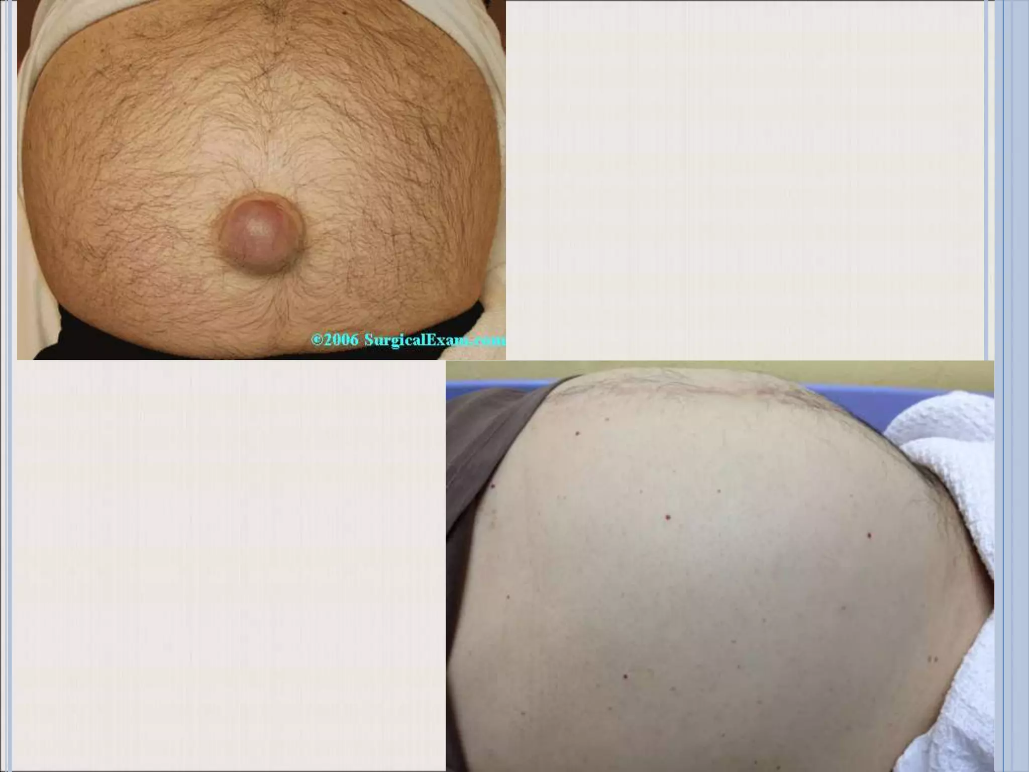 12a. Akut Abdomen.ppt