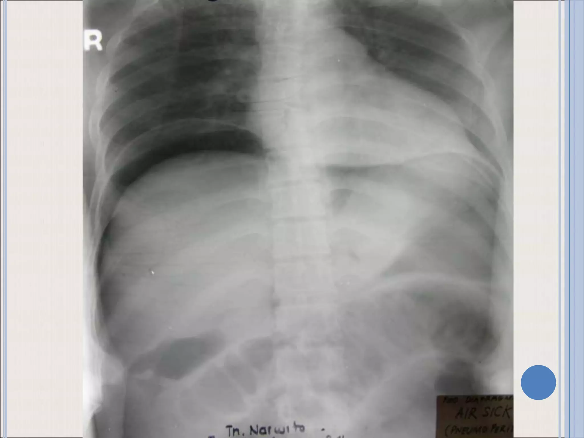 12a. Akut Abdomen.ppt