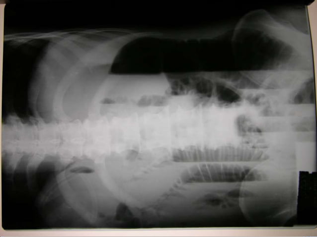 12a. Akut Abdomen.ppt