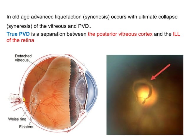 Anatomy and physiology Vitreous ppt final.pptx | Eye and Vision ...