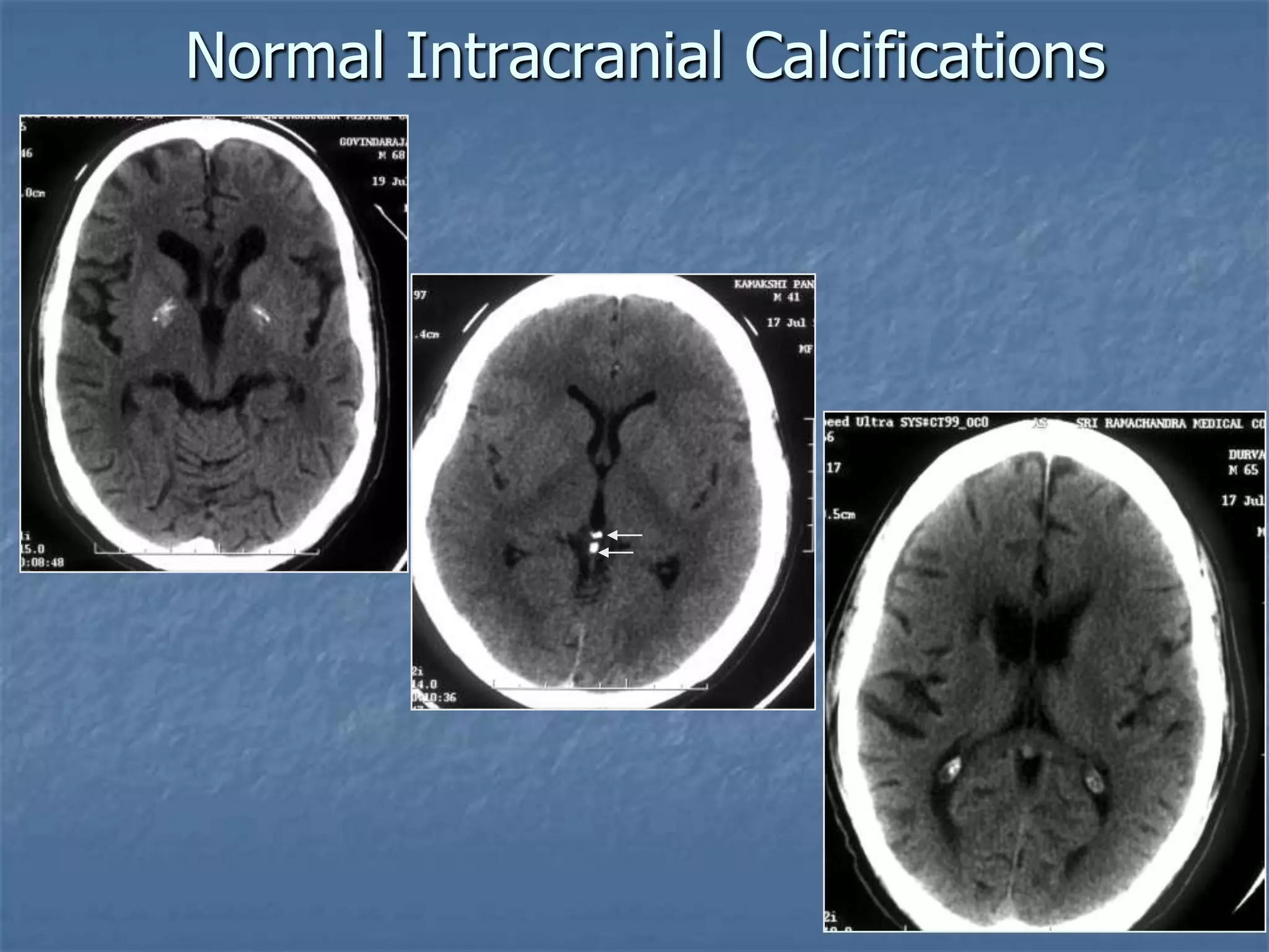 12 b. ct brain | PPT