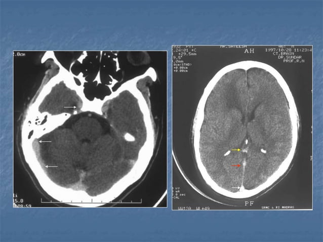 12 b. ct brain | PPT | Death, Injury, or Military Conflict | Sensitive Topics