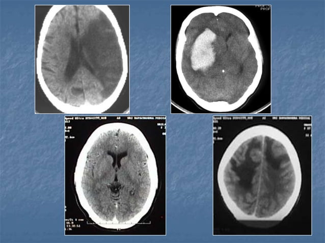 12 b. ct brain | PPT