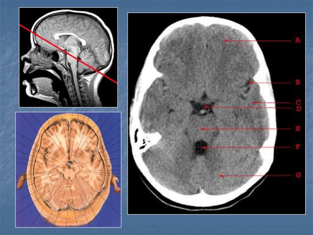 12 b. ct brain | PPT