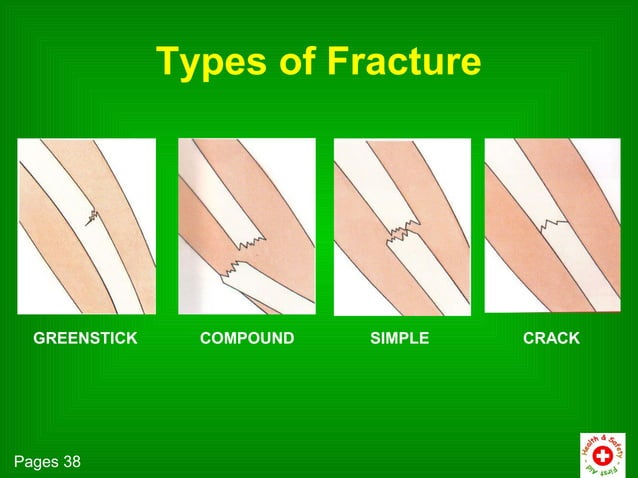 12 bone, joint and muscle injuries | PPT | First Aid | Injuries