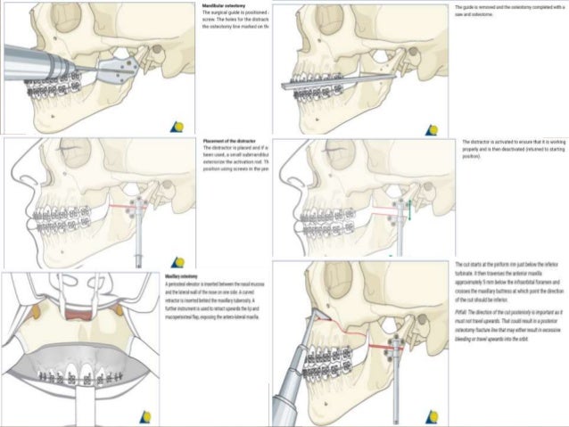 canted occlusal plane